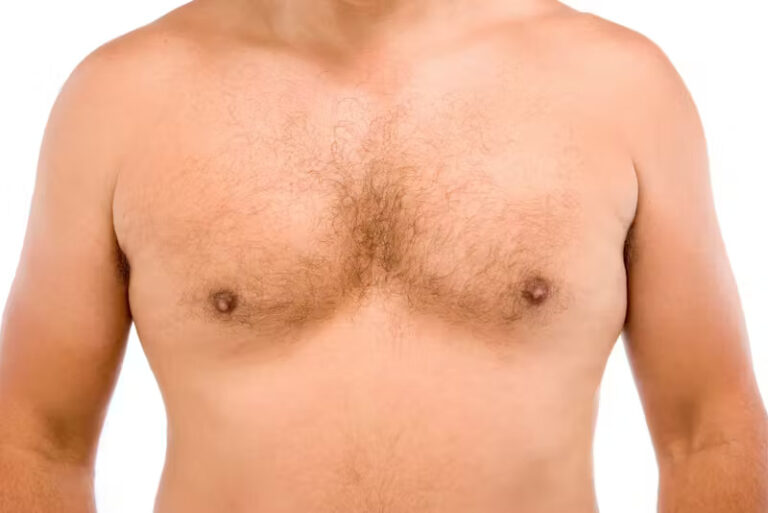 Benefits Of Gynecomastia Removal Surgery – Gynecomastia Removal Surgery